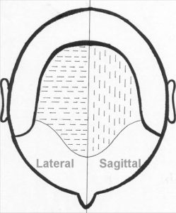 Lateral Slits Technique